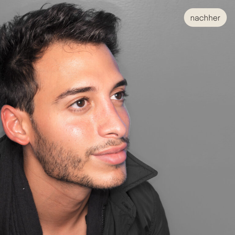 Kinnkorrektur (Genioplastik) für harmonische Gesichtszüge - SailerClinic