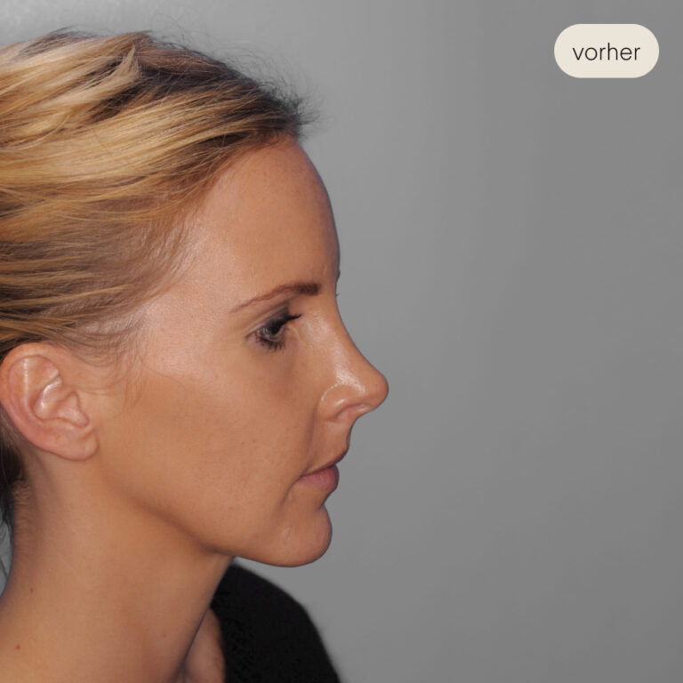 Kinnkorrektur (Genioplastik) für harmonische Gesichtszüge - SailerClinic